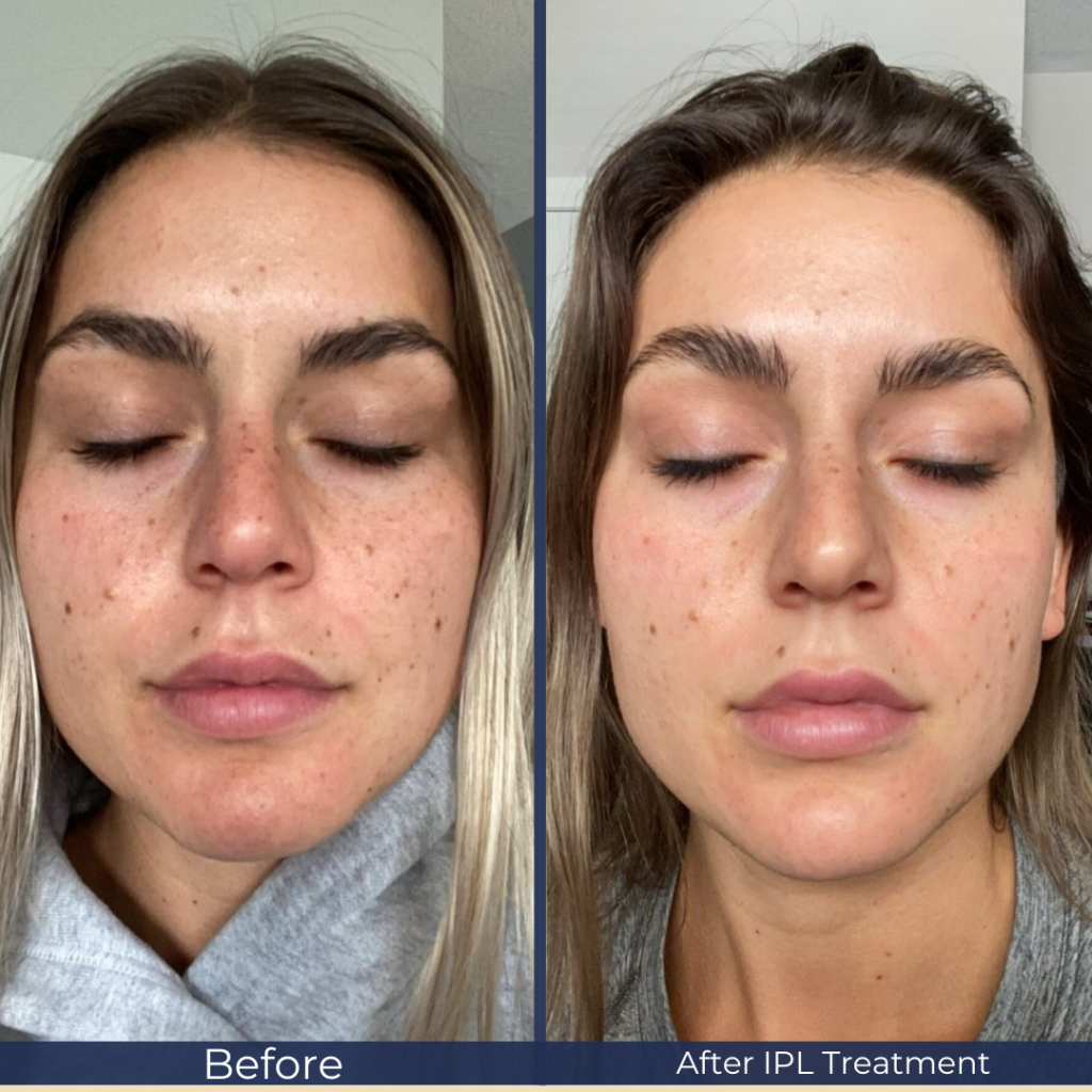 4D Laser Facelift - MONARCH MD & HAIR LAB MD