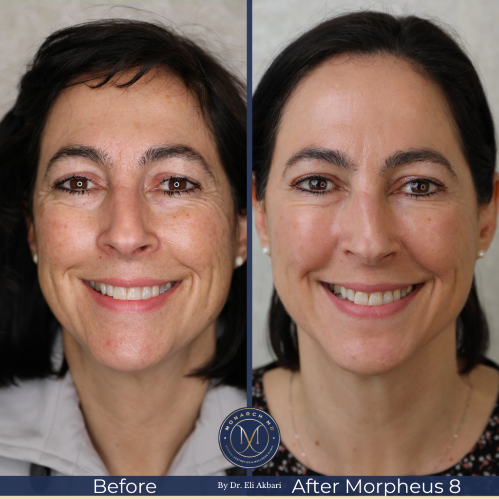 Morpheus 8 Skin Tightening | Achieve Youthful, Radiant Skin