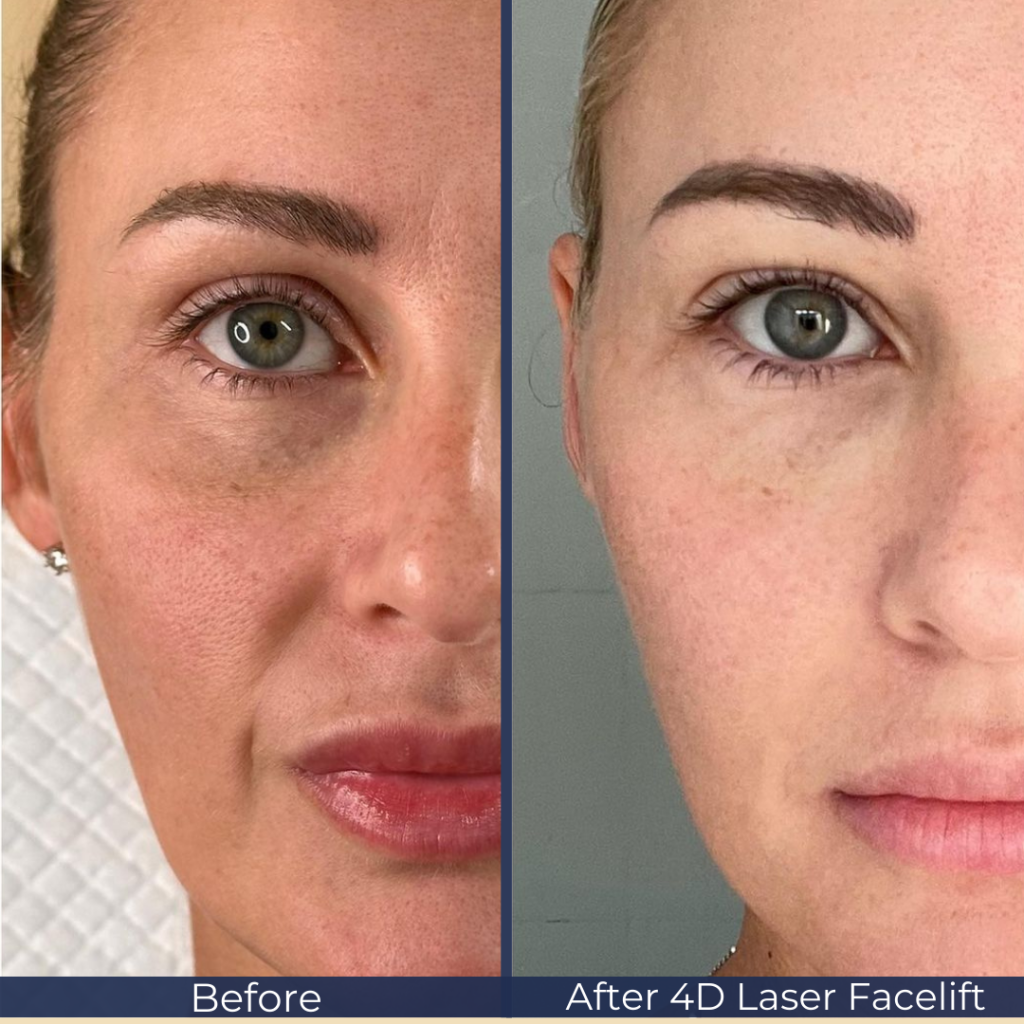 4D Laser Facelift - MONARCH MD & HAIR LAB MD