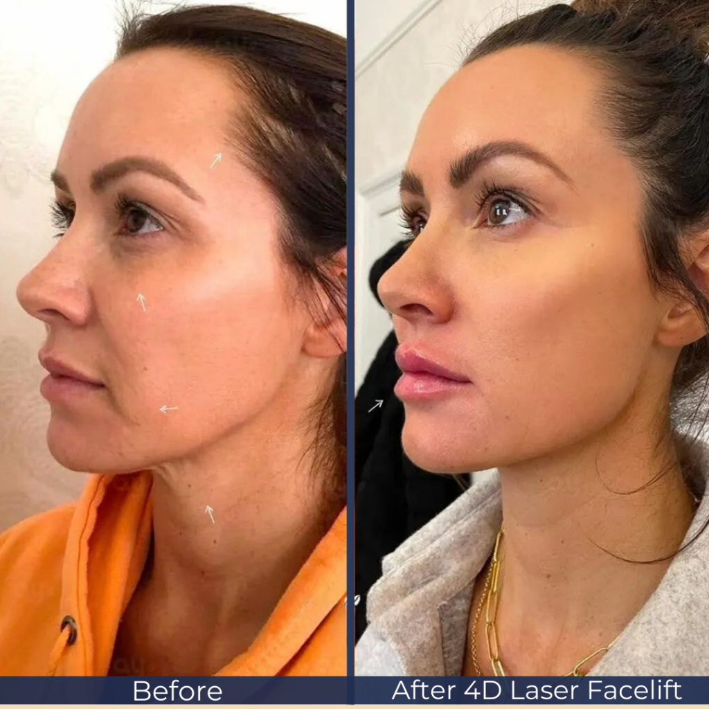 4D Laser Facelift - MONARCH MD & HAIR LAB MD