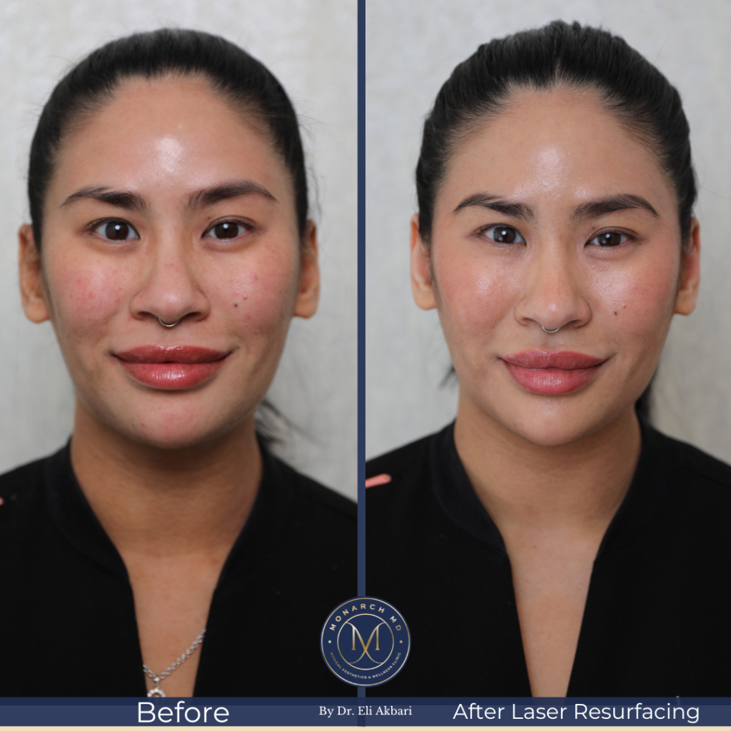 Fractional Resurfacing - MONARCH MD & HAIR LAB MD