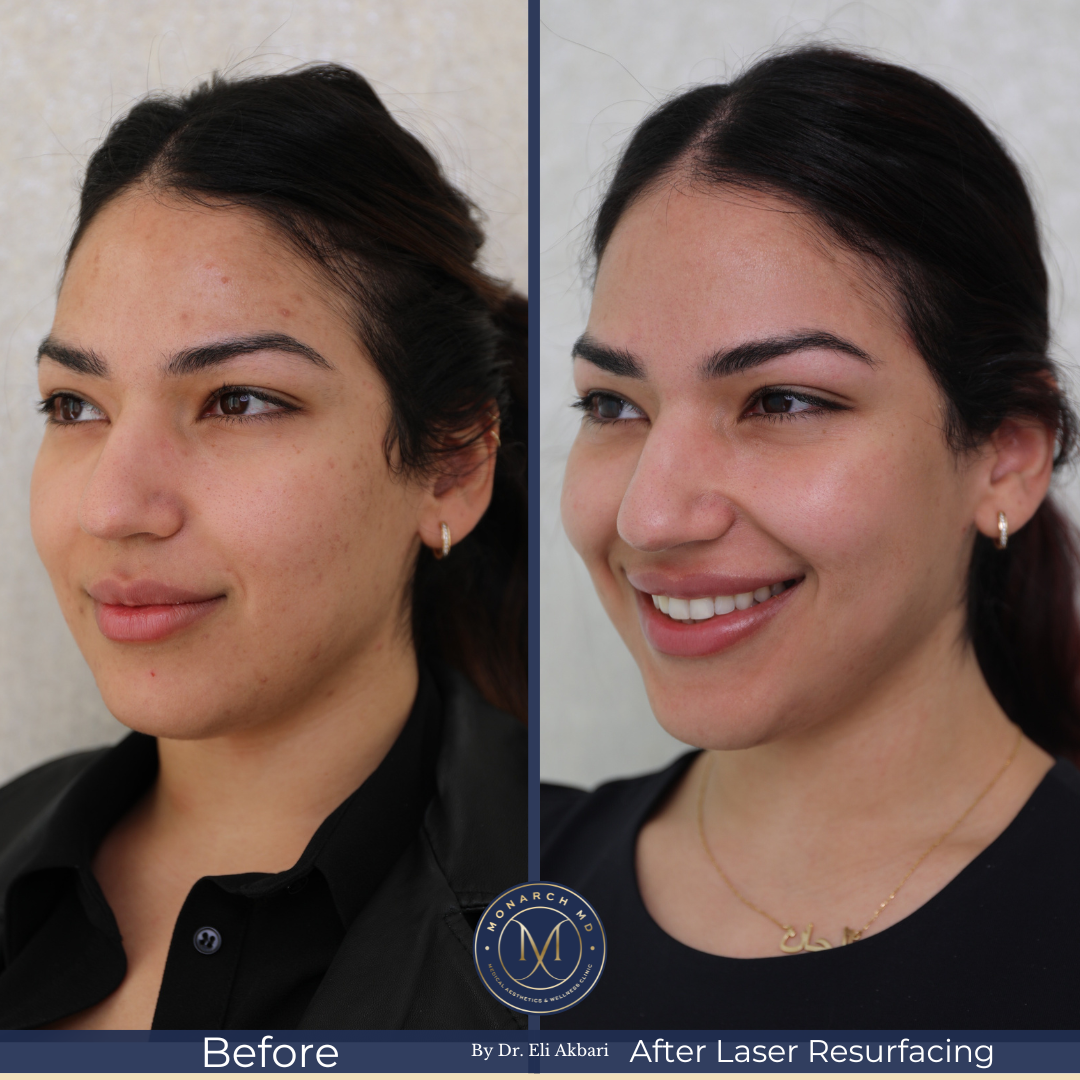 Fractional Resurfacing - MONARCH MD & HAIR LAB MD