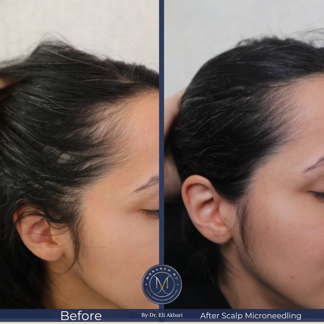 Scalp Microneedling - MONARCH MD & HAIR LAB MD