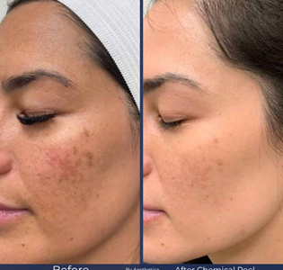 Chemical peel - MONARCH MD & HAIR LAB MD